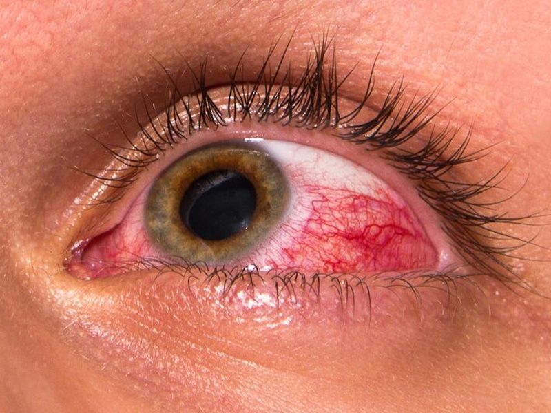 Preseptal Cellulitis: Symptoms, Treatment, and Prevention Guide