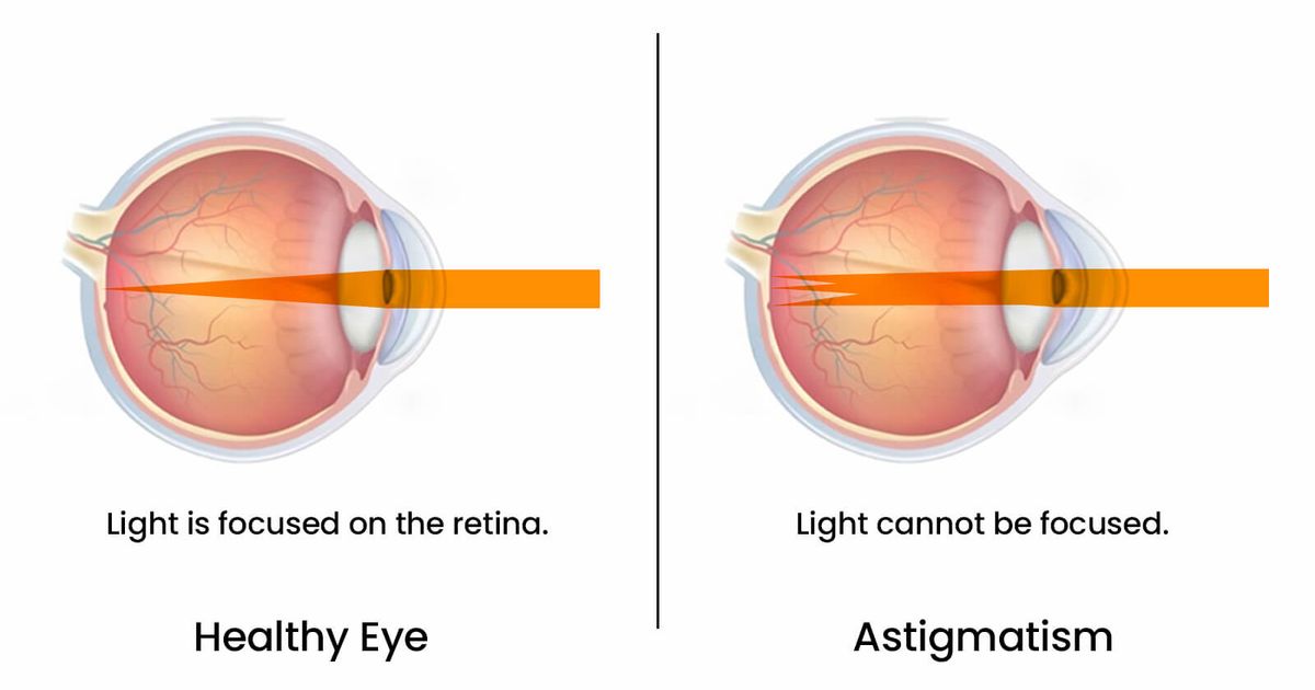 What is Astigmatism? Astigmatism Vs. Normal Vision
